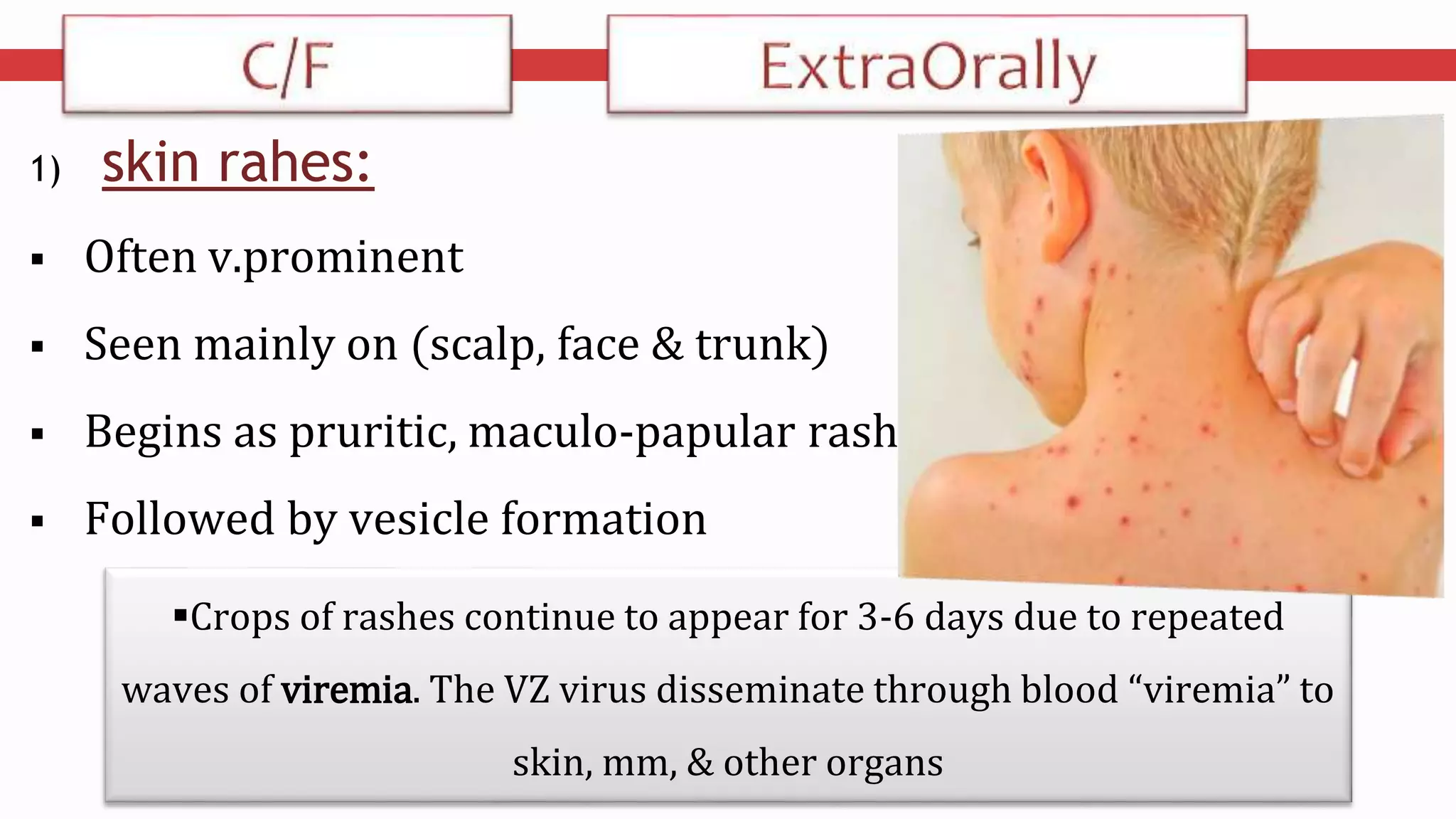 6 vb lesions (2) vzv + ramsy hunty s | PPTX