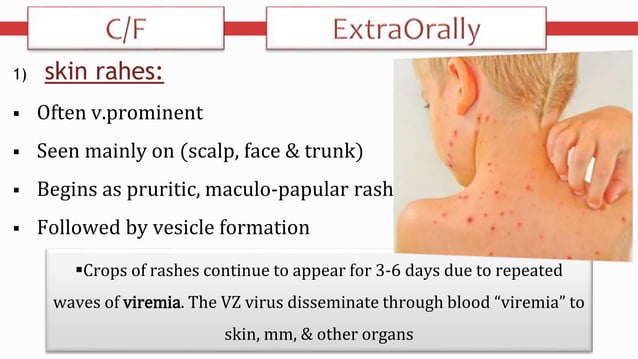 6 vb lesions (2) vzv + ramsy hunty s | PPTX