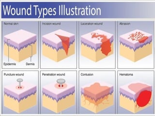 Wound Care and types and management that in health care system | PPT