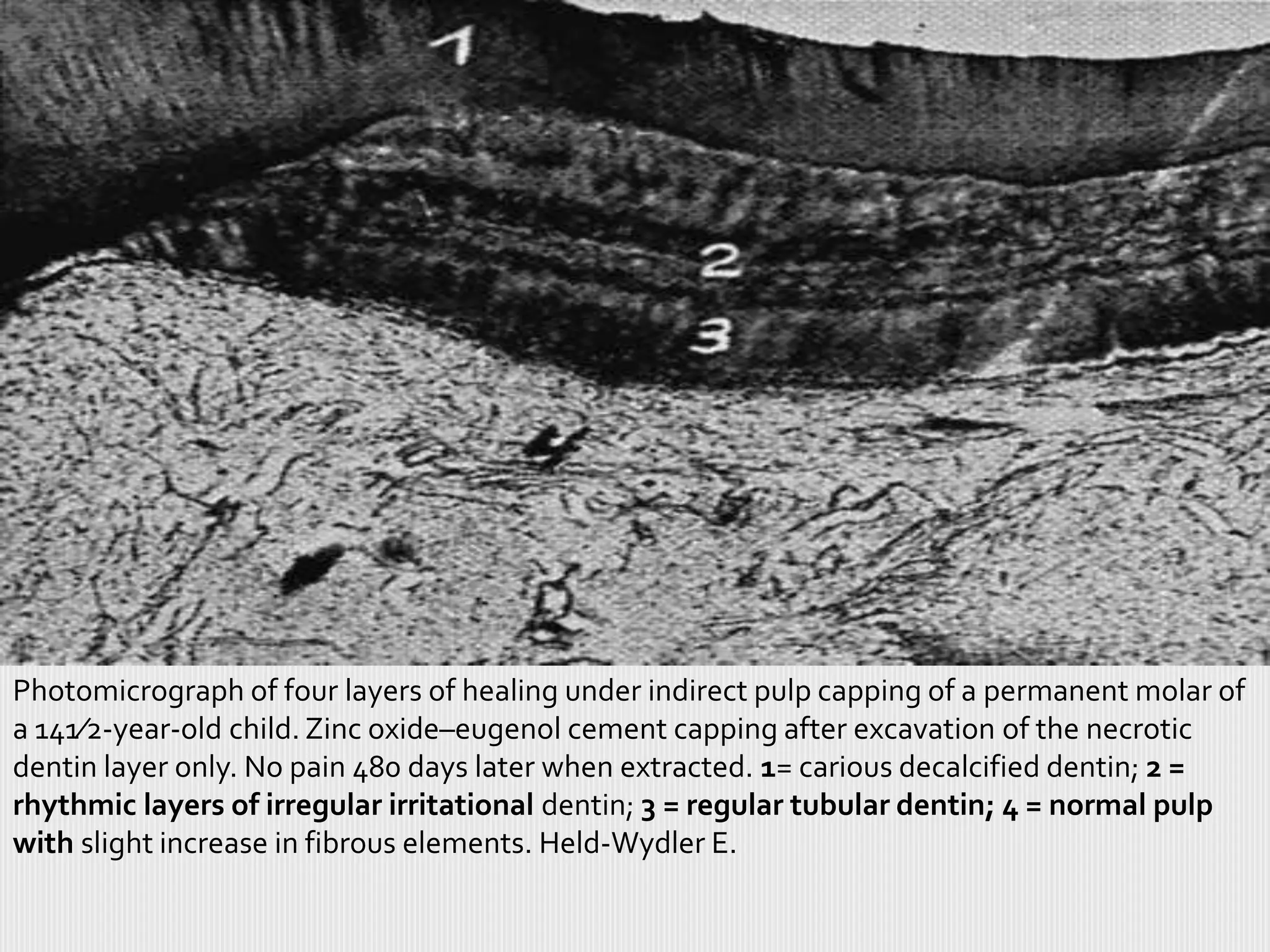 young permanent tooth | PPTX | Dental Health | Diseases and Conditions