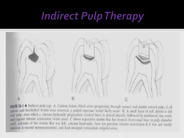 young permanent tooth