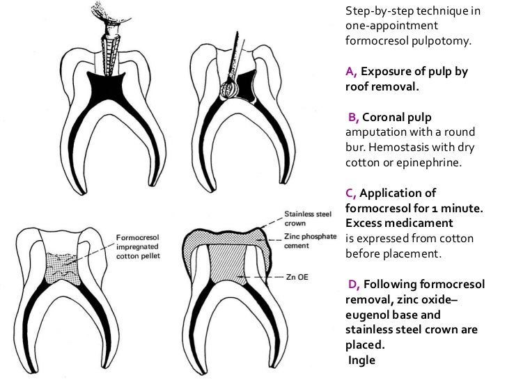 young permanent tooth