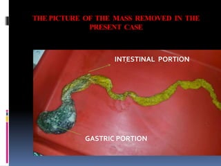 E POSTER POWER POINT SLIDES FOR RAPUNZEL'S SYNDROME | PPTX