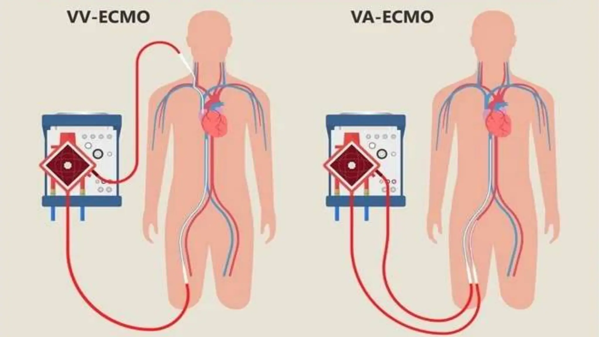 608770180-ECHMO.pptx detailed explanation | PPTX