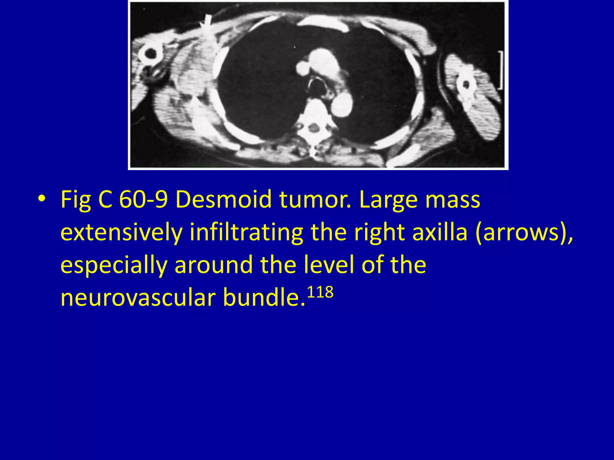 60 axillary masses on computed tomography | PPTX