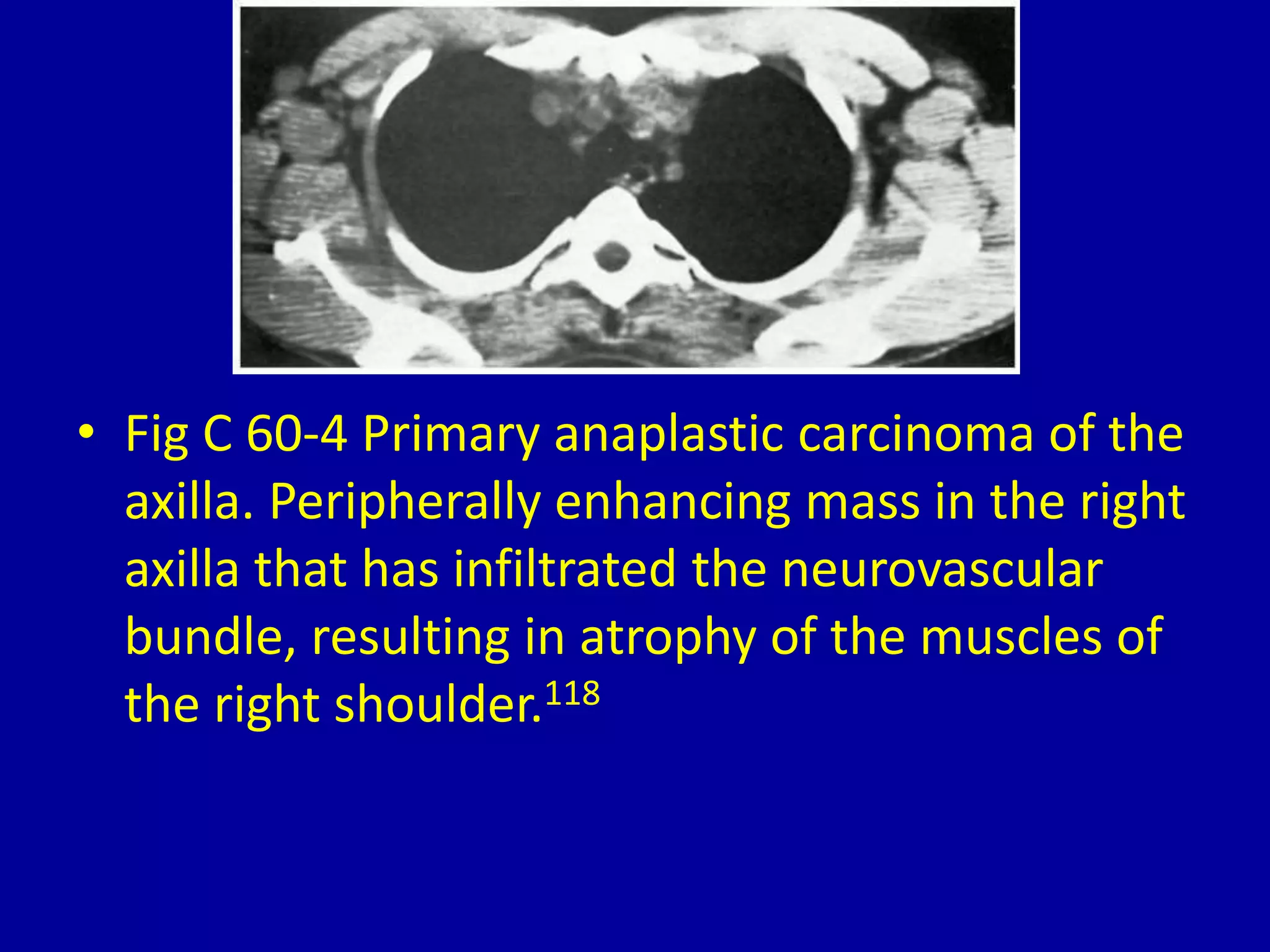 60 axillary masses on computed tomography | PPTX