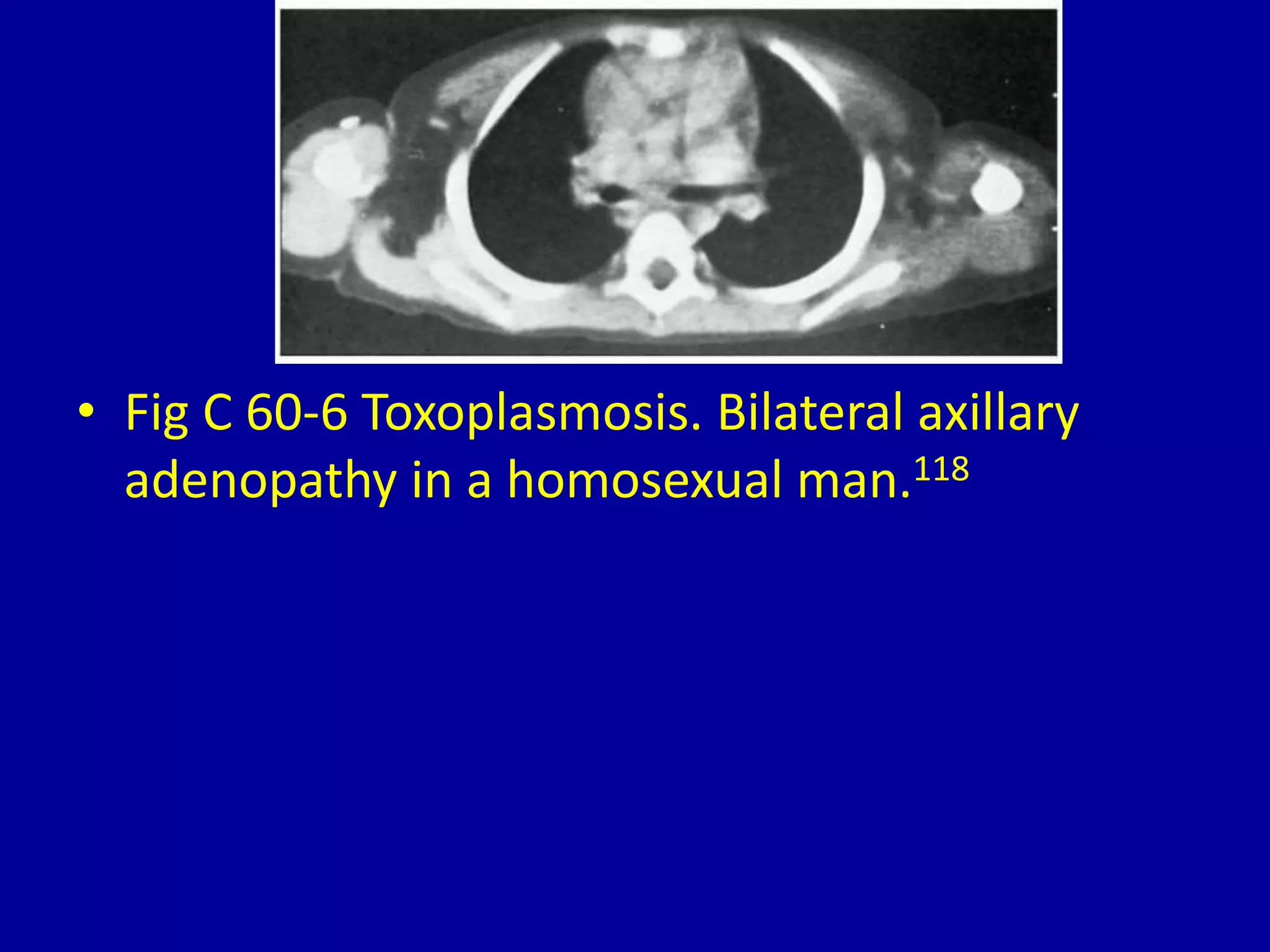 60 axillary masses on computed tomography | PPTX