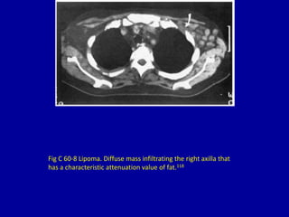 60 axillary masses on computed tomography | PPTX