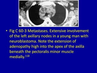 60 axillary masses on computed tomography | PPTX