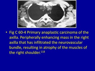 60 axillary masses on computed tomography | PPTX