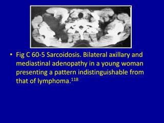 60 axillary masses on computed tomography | PPTX