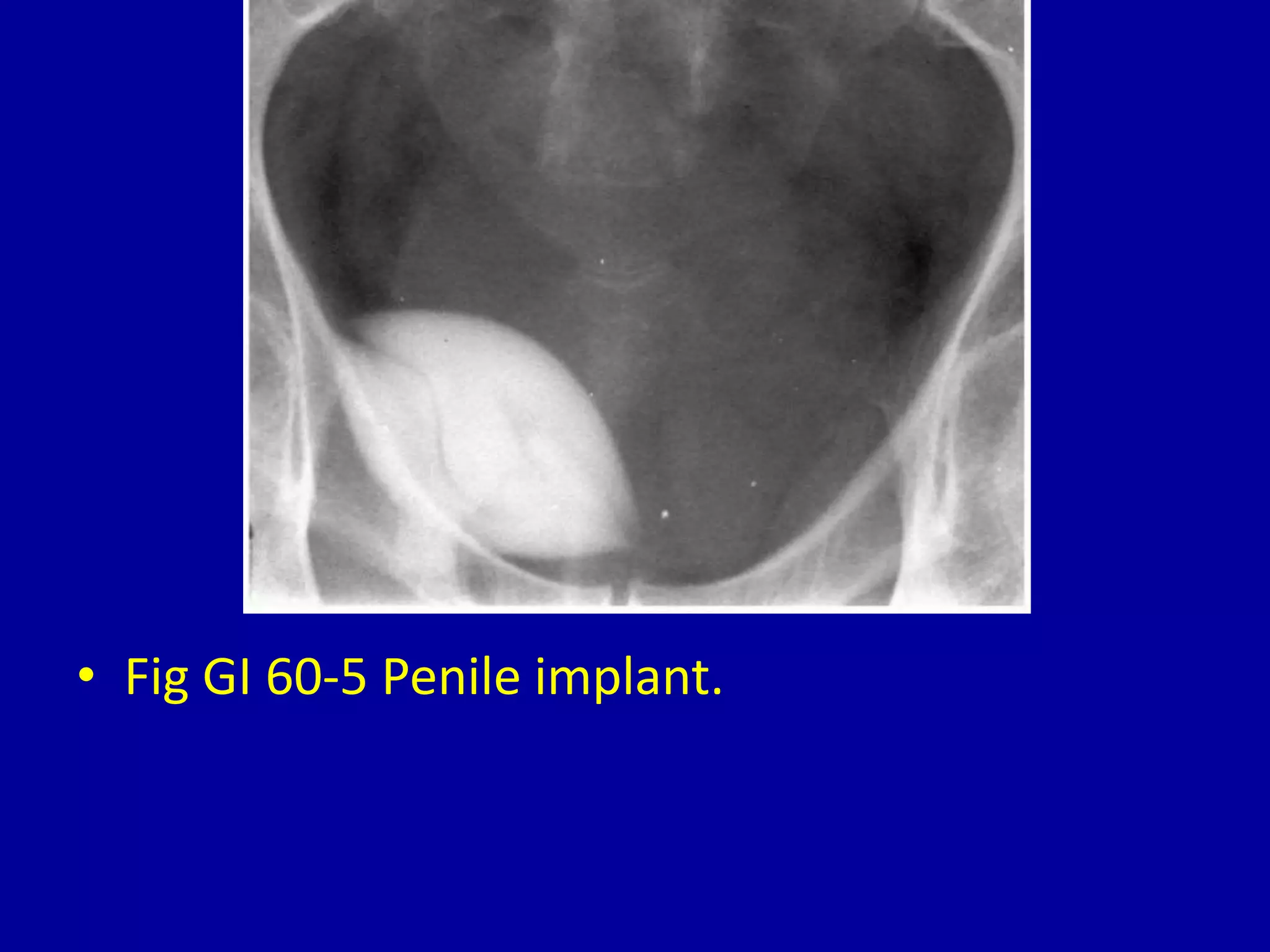 60 male genital tract calcification | PPT