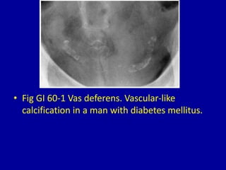 60 male genital tract calcification | PPT