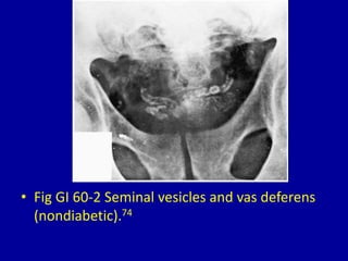 60 male genital tract calcification | PPT