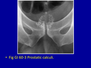 60 male genital tract calcification | PPT
