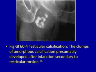 60 male genital tract calcification | PPT