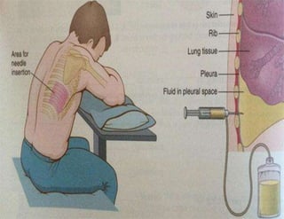 Thoracentesis | PPTX
