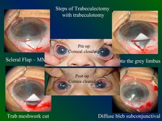 Congenital Glaucoma | PPT