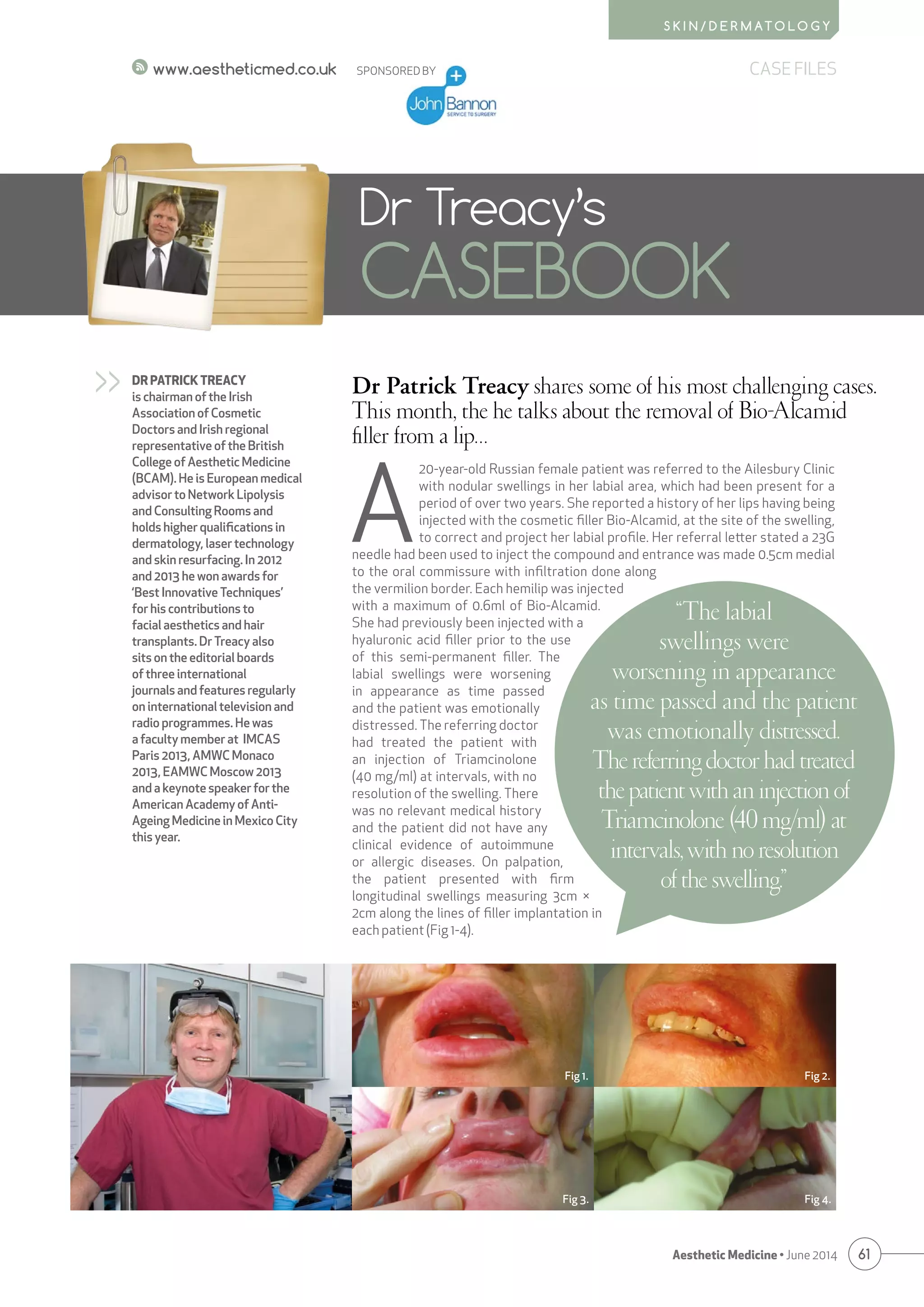 Removal of Bio-Alcamid from a lip | PDF