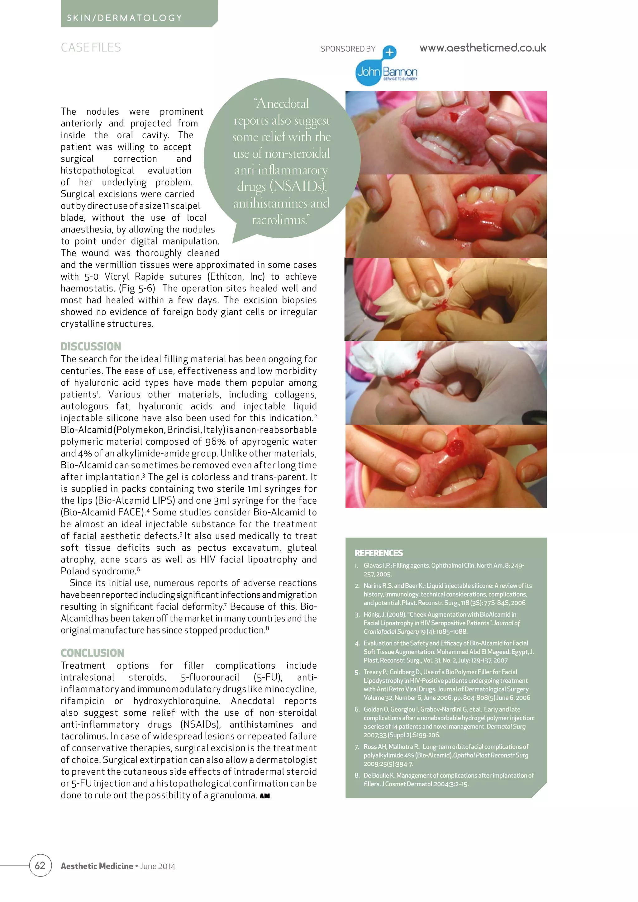 Removal of Bio-Alcamid from a lip | PDF