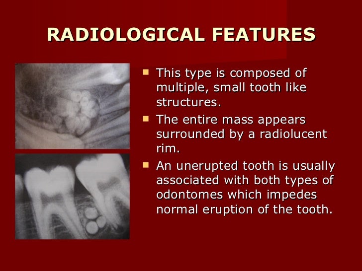 COMPOUND ODONTOMA