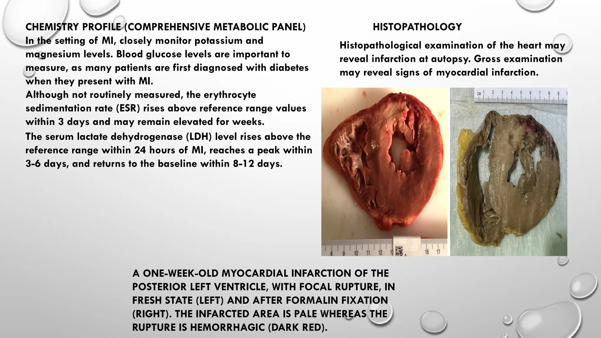 Laboratory Diagnostics of Myocardial Infarction, Myocarditis and Heart ...