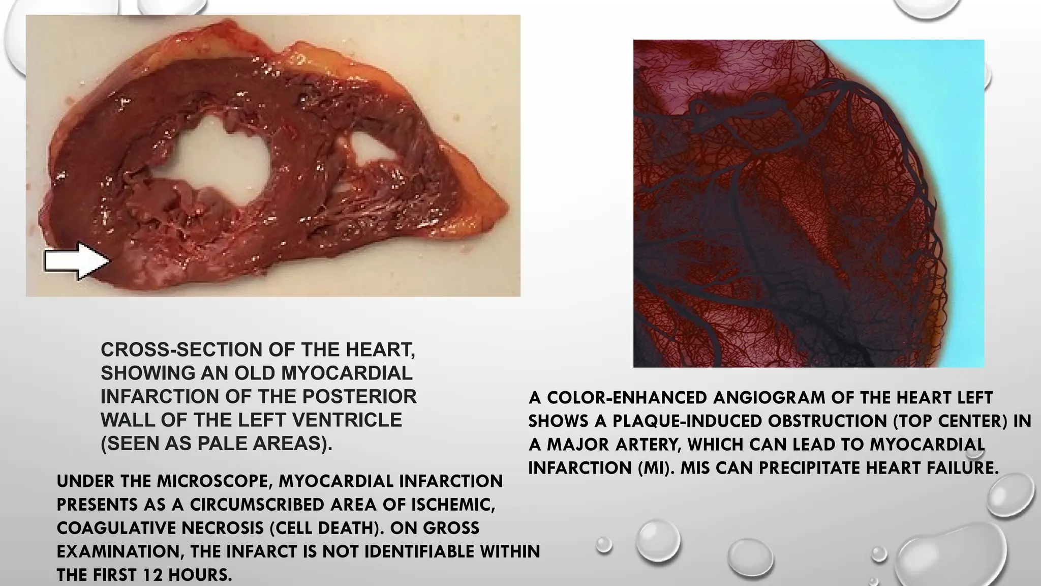 Laboratory Diagnostics of Myocardial Infarction, Myocarditis and Heart ...