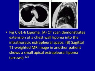 61 chest wall lesions on computed tomography and | PPTX