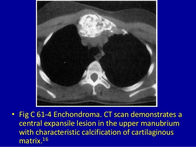 61 chest wall lesions on computed tomography and