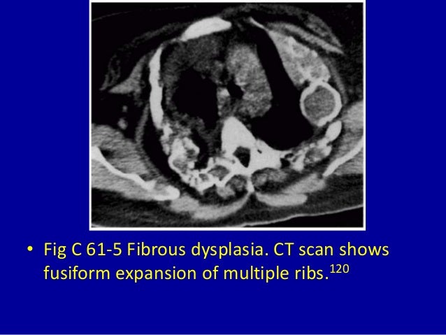 61 chest wall lesions on computed tomography and