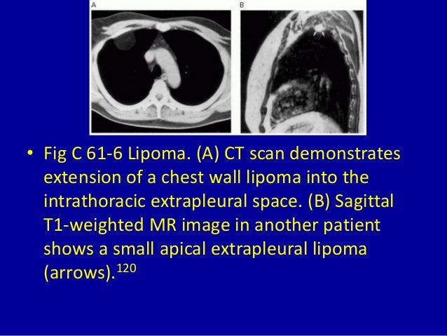 61 chest wall lesions on computed tomography and