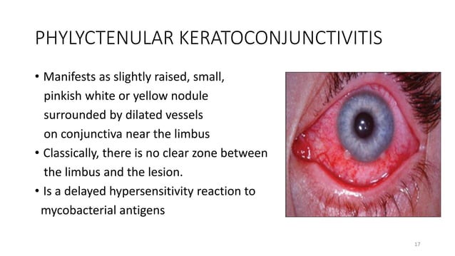 620_Ocular_Tuberculosis.pptx | Eye and Vision Conditions | Diseases and ...