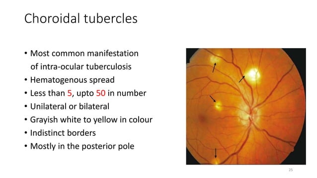 620_Ocular_Tuberculosis.pptx | Eye and Vision Conditions | Diseases and ...
