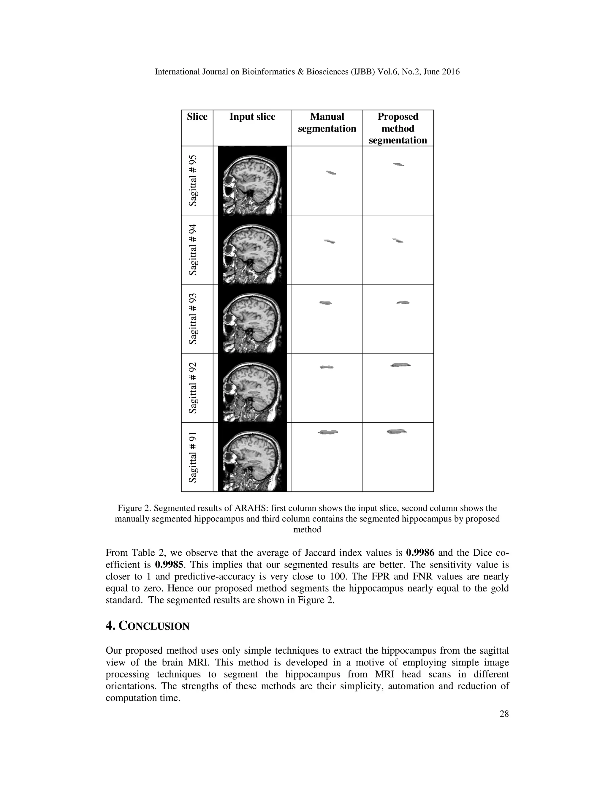 A SIMPLE APPROACH FOR RELATIVELY AUTOMATED HIPPOCAMPUS SEGMENTATION FROM SAGITTAL VIEW OF BRAIN ...