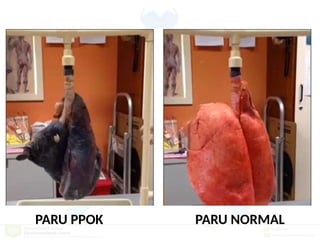 Penyakit paru obstruktif, PPT, edukasi masyarakat | PPTX