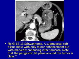 62 gastric diseases on computed tomography | PPTX