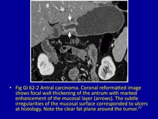 62 gastric diseases on computed tomography | PPTX