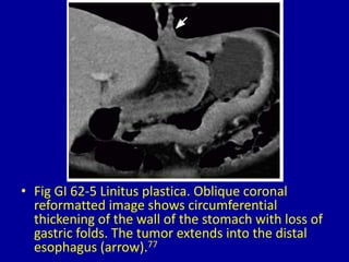 62 gastric diseases on computed tomography | PPT