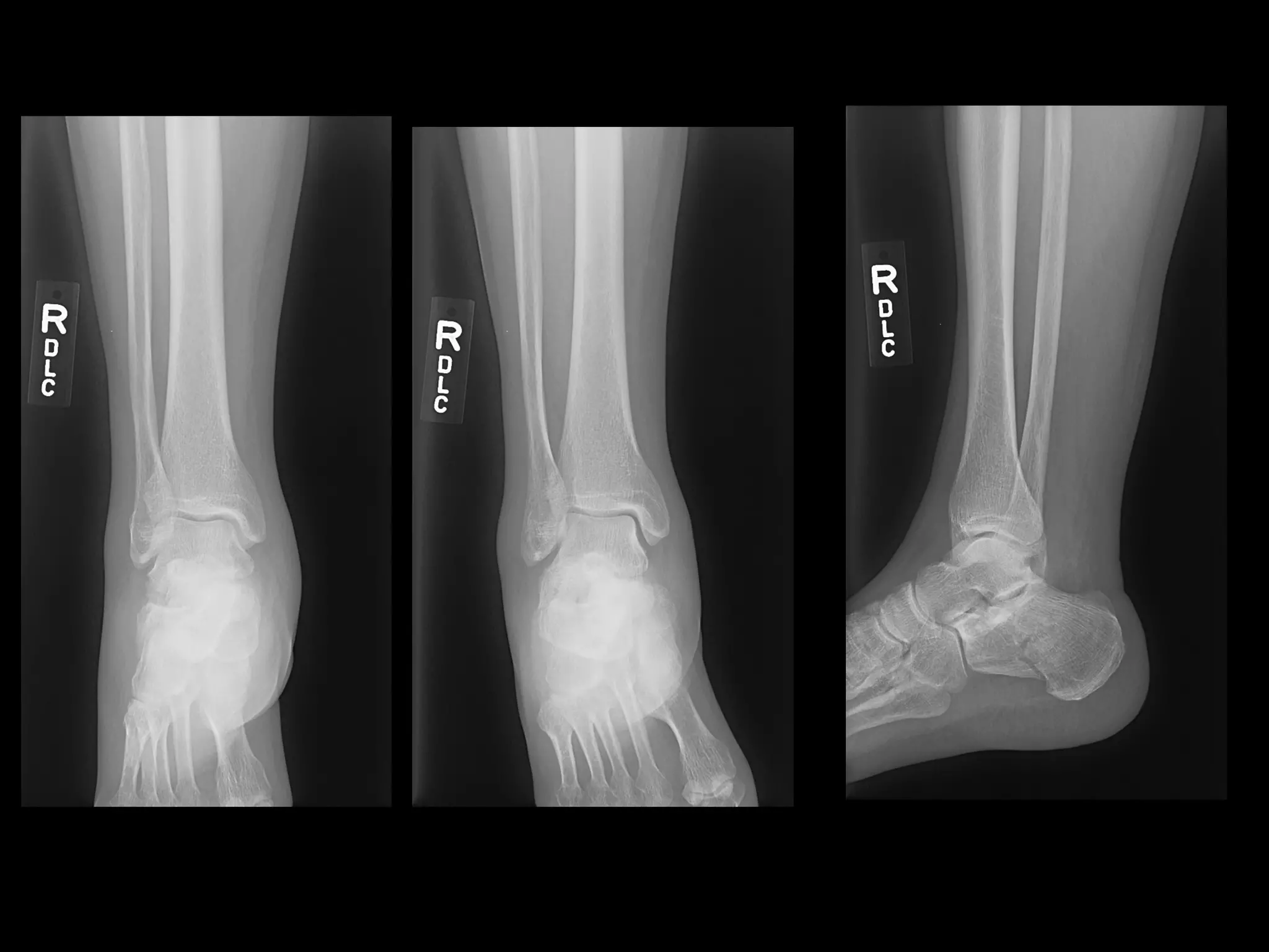 Radiology Rounds: 62 year old male with pain after fall | PPT Radiology Rounds: 62 year old male with pain after fall | PPT