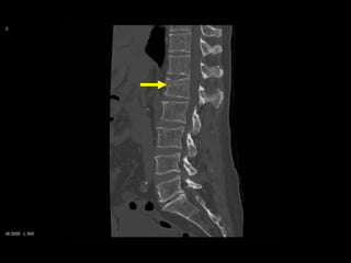 Radiology Rounds: 62 year old male with pain after fall | PPT