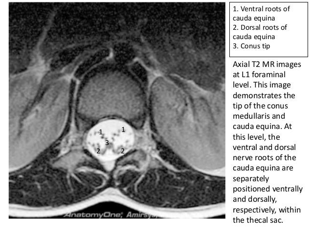 Resource with labeled individual spinal nerves at the level of the ...