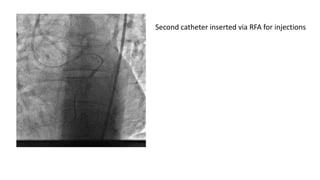 Lost Balloon - Manish Ramlall | PPTX | Medical Health