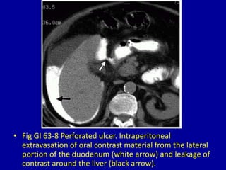 63 duodenal diseases on computed tomography | PPTX