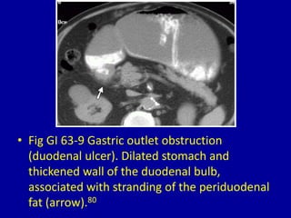 63 duodenal diseases on computed tomography | PPTX