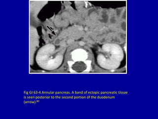 63 duodenal diseases on computed tomography | PPTX