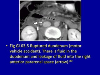 63 duodenal diseases on computed tomography | PPTX