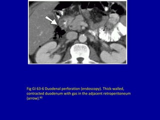 63 duodenal diseases on computed tomography | PPTX