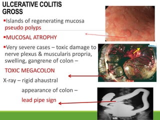 64-GIT 6.pdf peptic ulcer ND GASTRIC ULCer | PDF