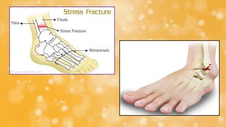 Stress Fractures on emergency department.pptx