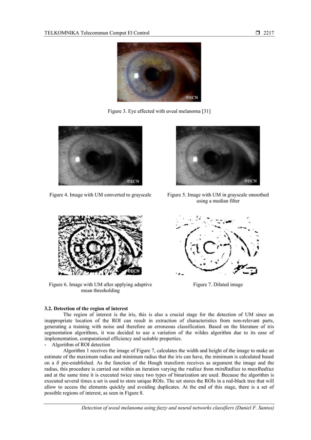 Detection of uveal melanoma using fuzzy and neural networks classifiers ...
